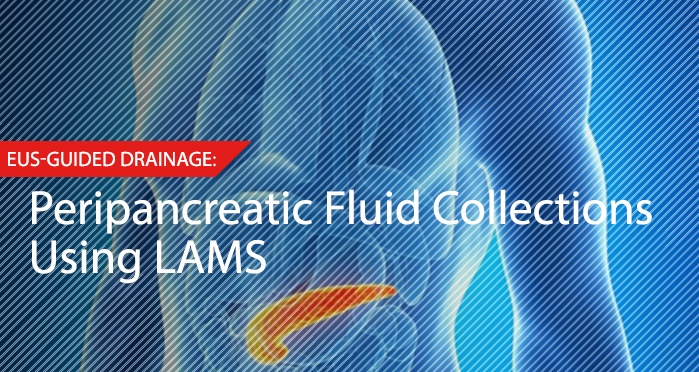 EUS-Guided drainage: Peripancreatic Fluid Collections using lams